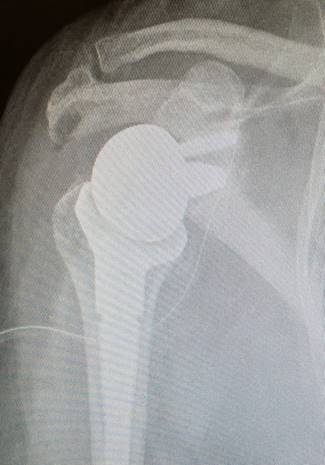 Reverse Total Shoulder Replacement